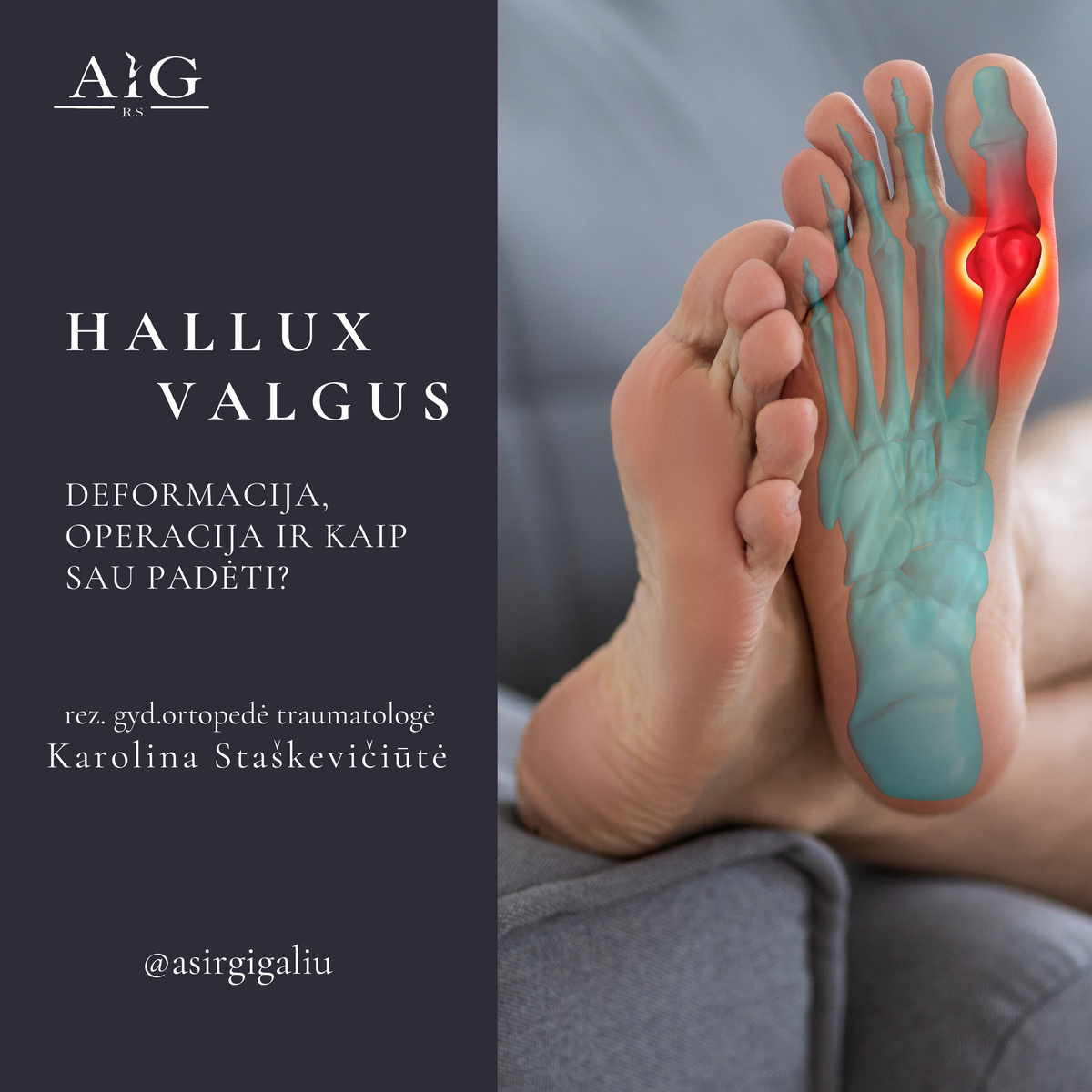 Hallux Valgus pėdos deformacija. Kas, kaip ir kodėl? – AŠ IRGI GALIU